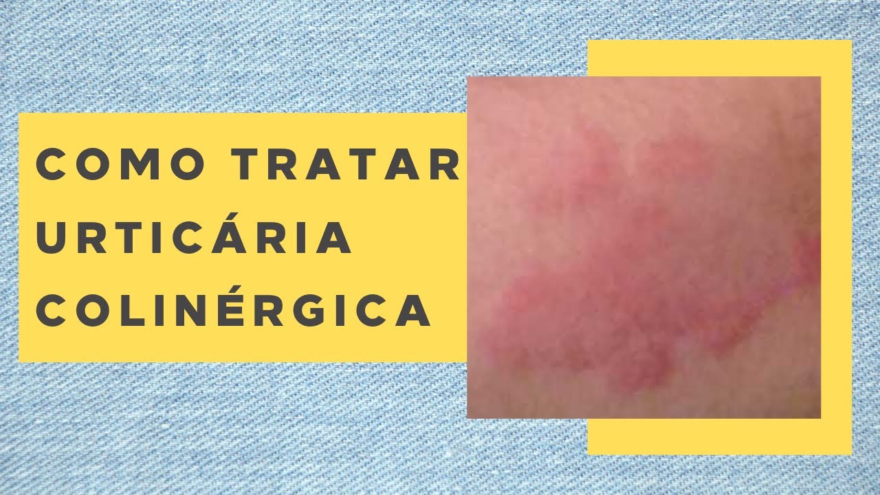 Urticária Colinérgica é Rara - RETOEDU