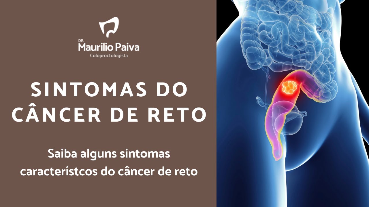 Conheça os sintomas do câncer de reto com o Dr. Maurilio Paiva ...