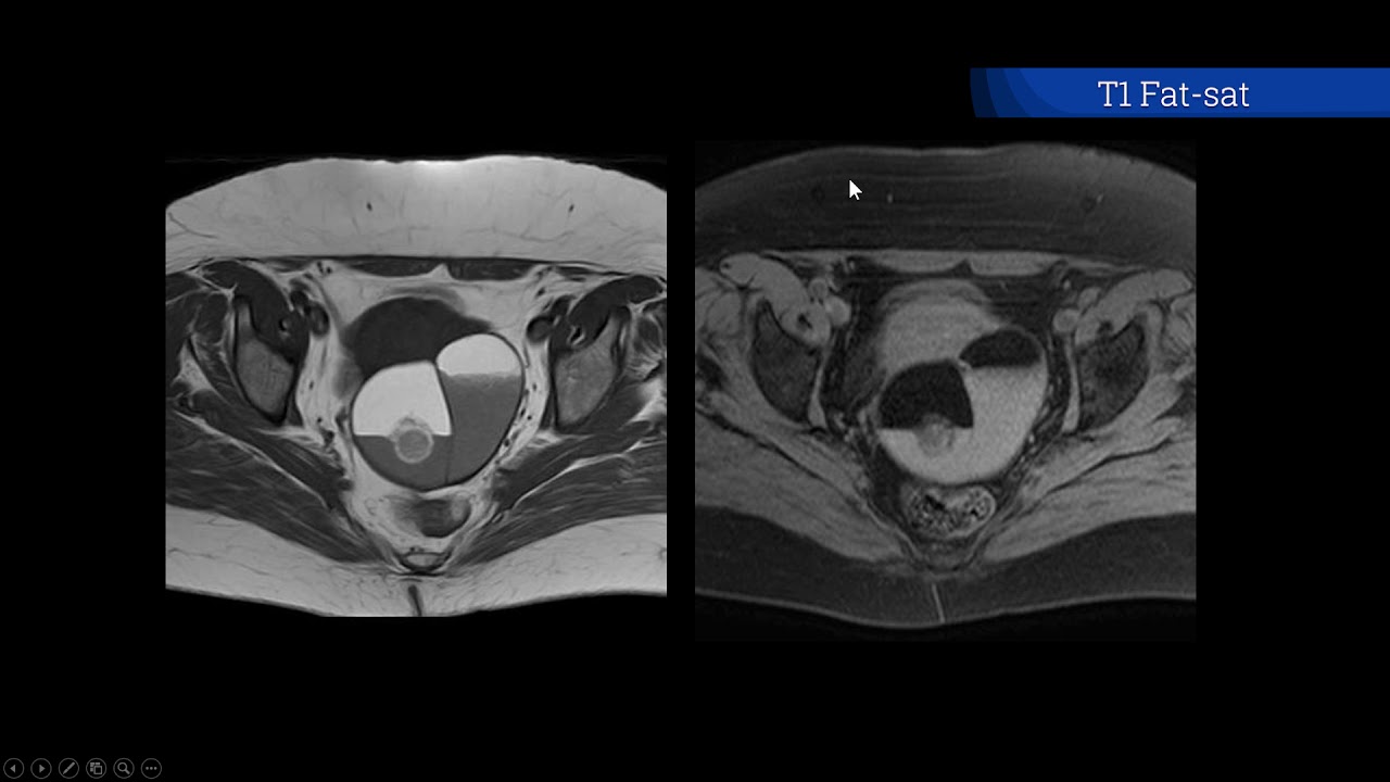 Cisto dermoide: causas, sintomas e tratamentos