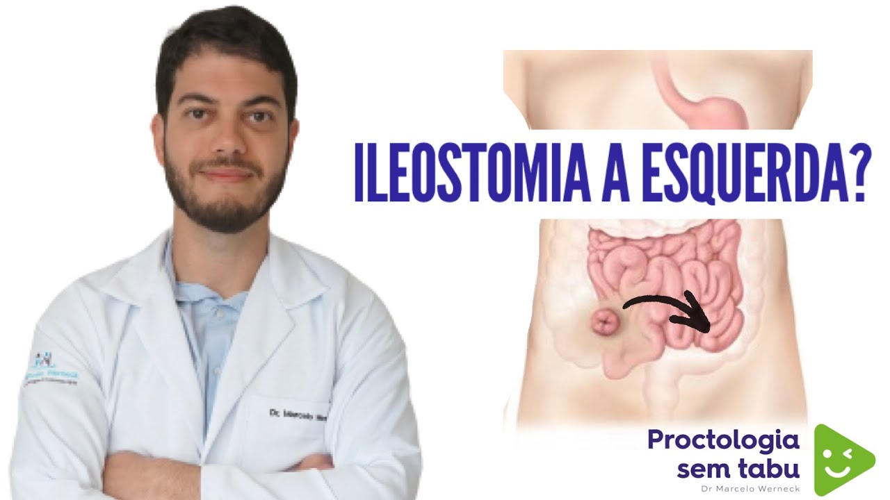 Ileostomia: localização do estoma na barriga
