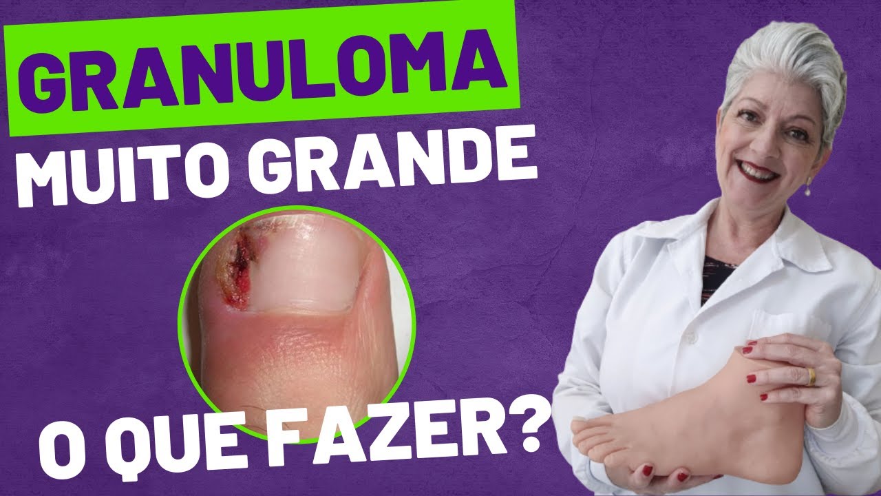 Granuloma grande e inflamado: como tratar?