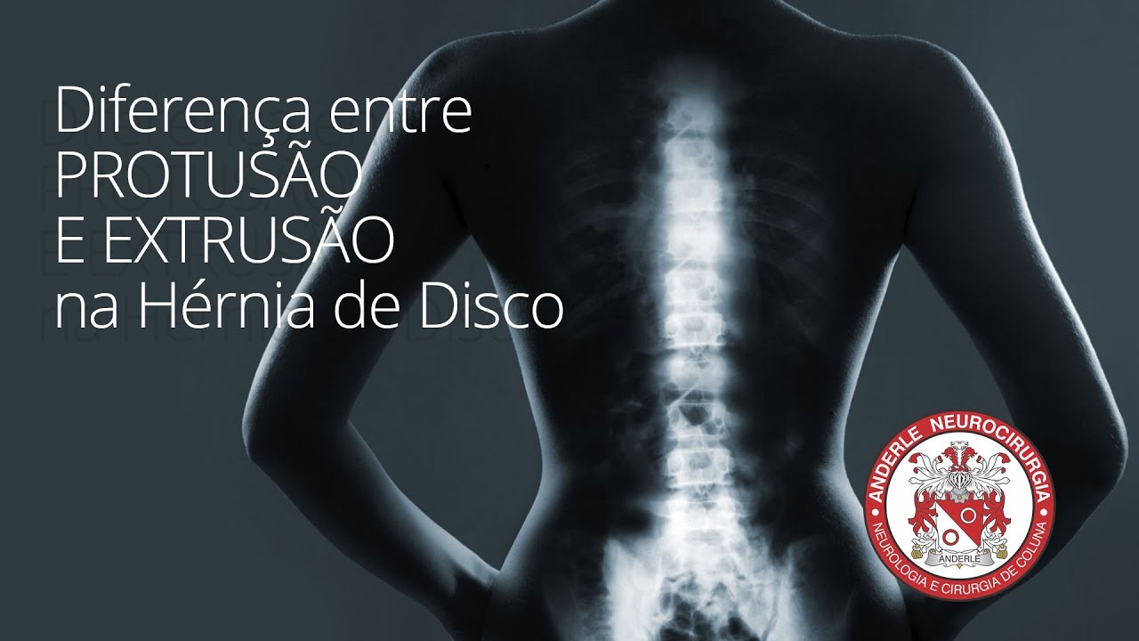 Hérnia de Disco: Entenda a diferença entre Protusão e Extrusão - Dr ...
