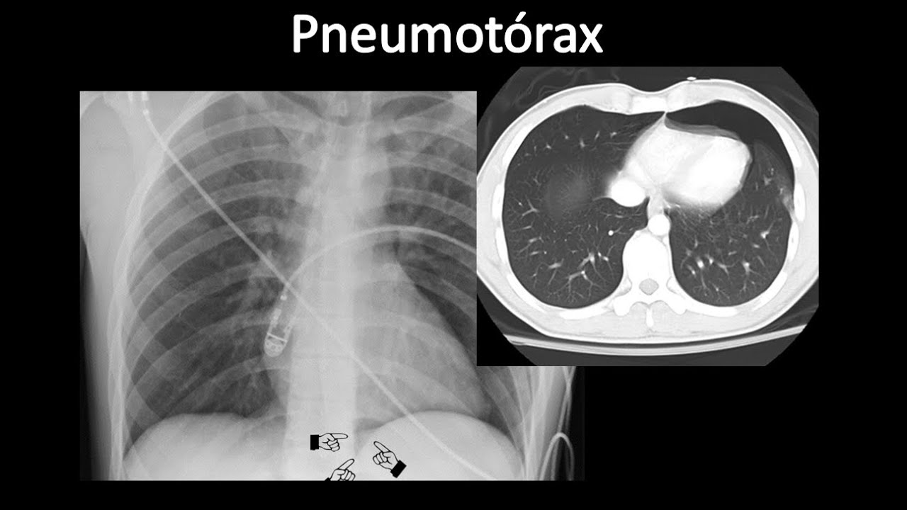 Descubra o que é Pneumotórax Oculto.