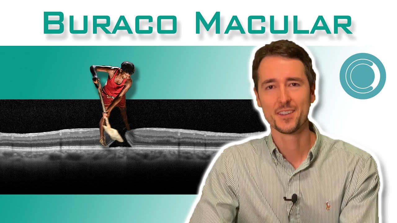 Entendendo o Buraco Macular: Causas, Sintomas e Tratamentos para a ...