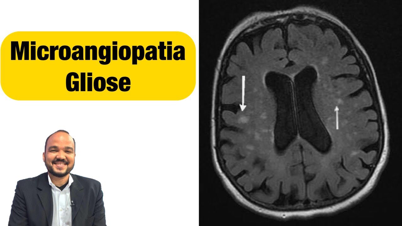 Gliose ou microangiopatia: causas, sintomas e tratamento.