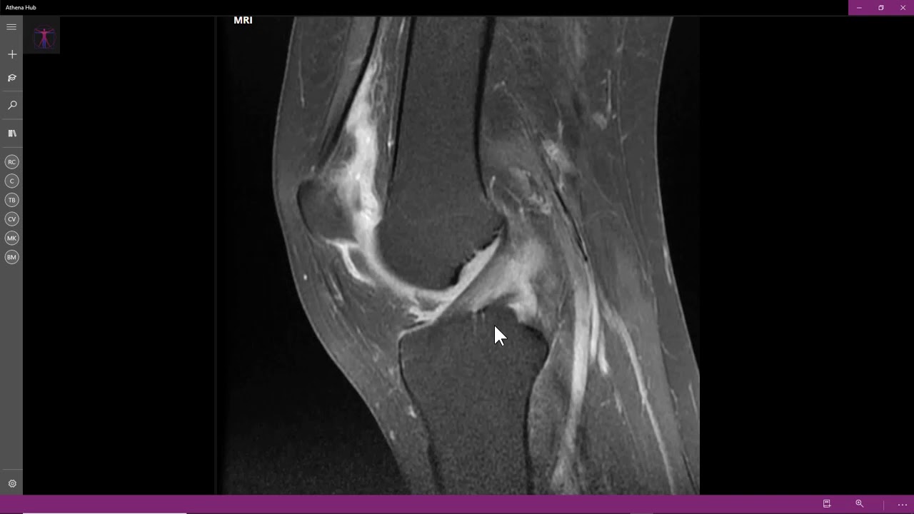 Sinovite: causas, sintomas e tratamento.