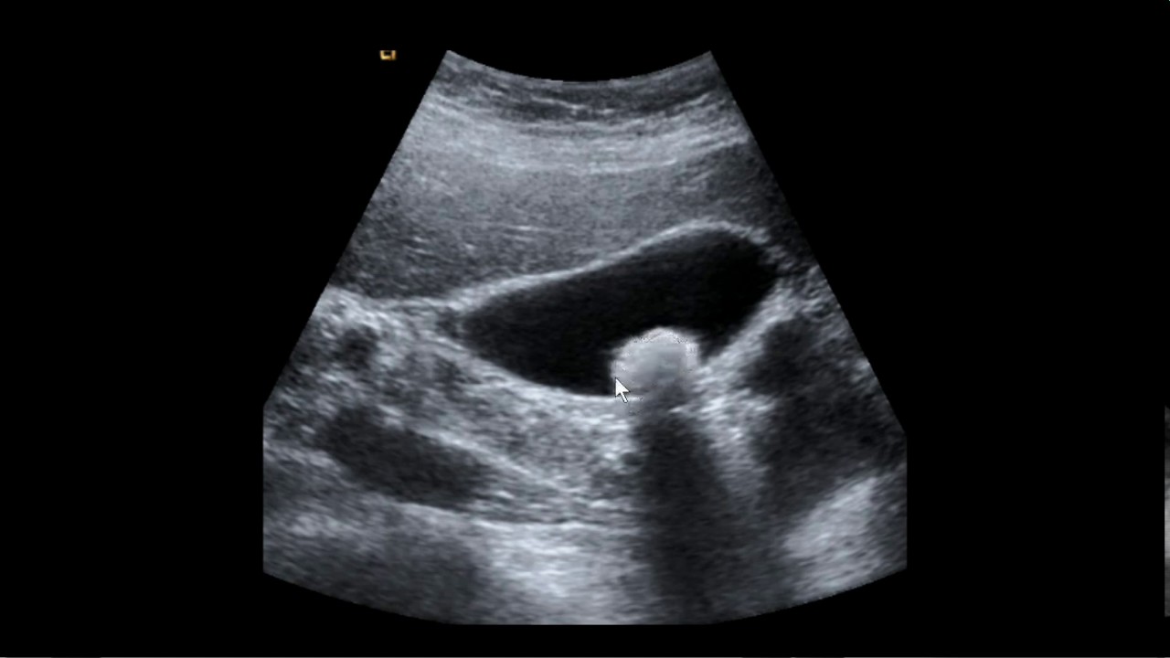 Cálculo na vesícula biliar: sintomas, causas e tratamento.