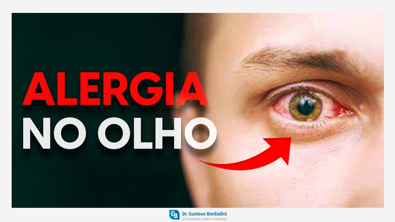 Conjuntivite alérgica: Causas, sintomas e tratamento - por Dr. Gustavo ...